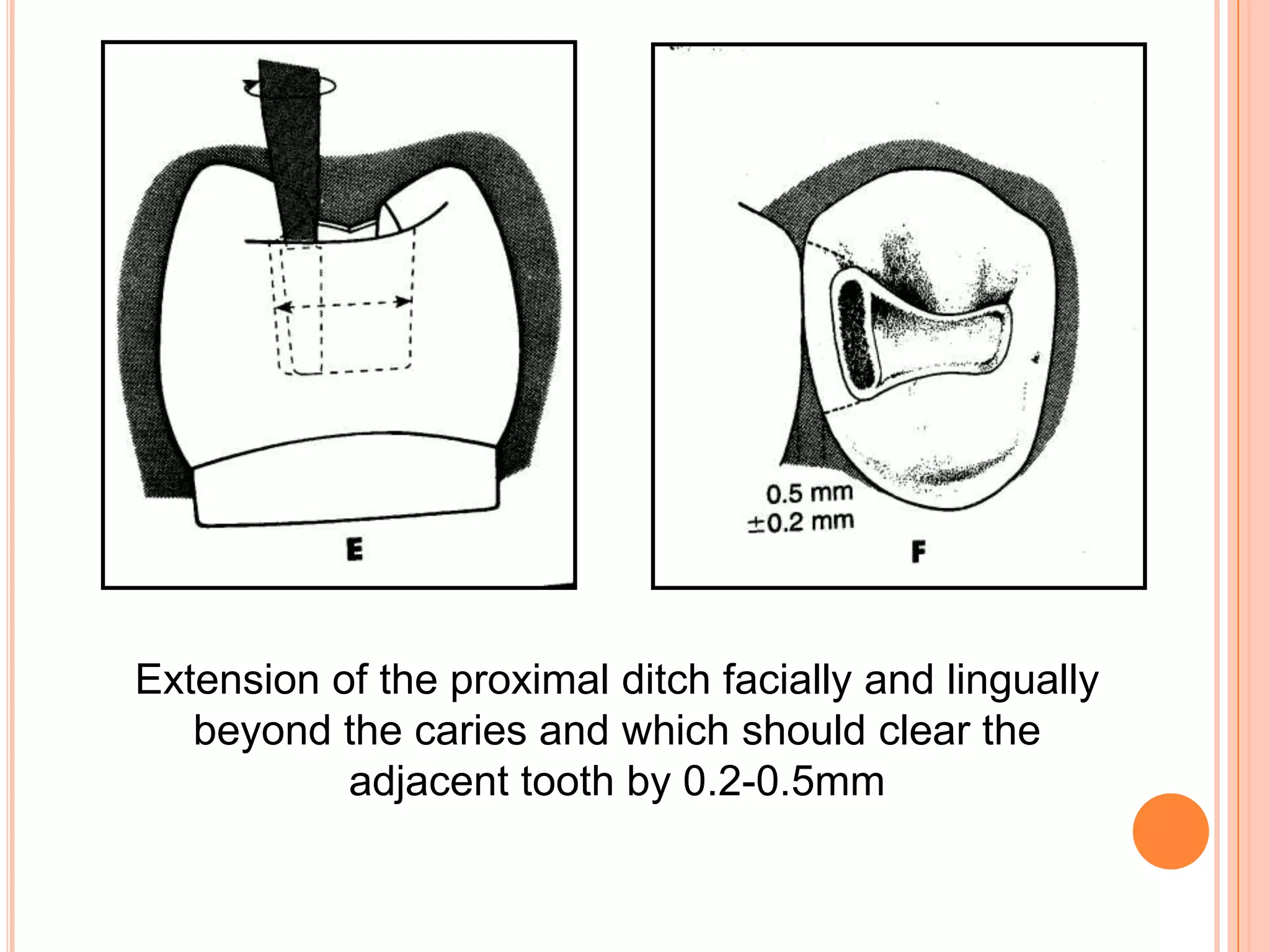 Cast gold Inlay restorations | PPTX