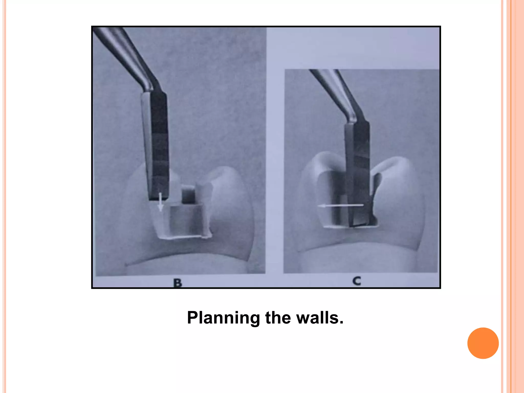 Cast gold Inlay restorations | PPTX