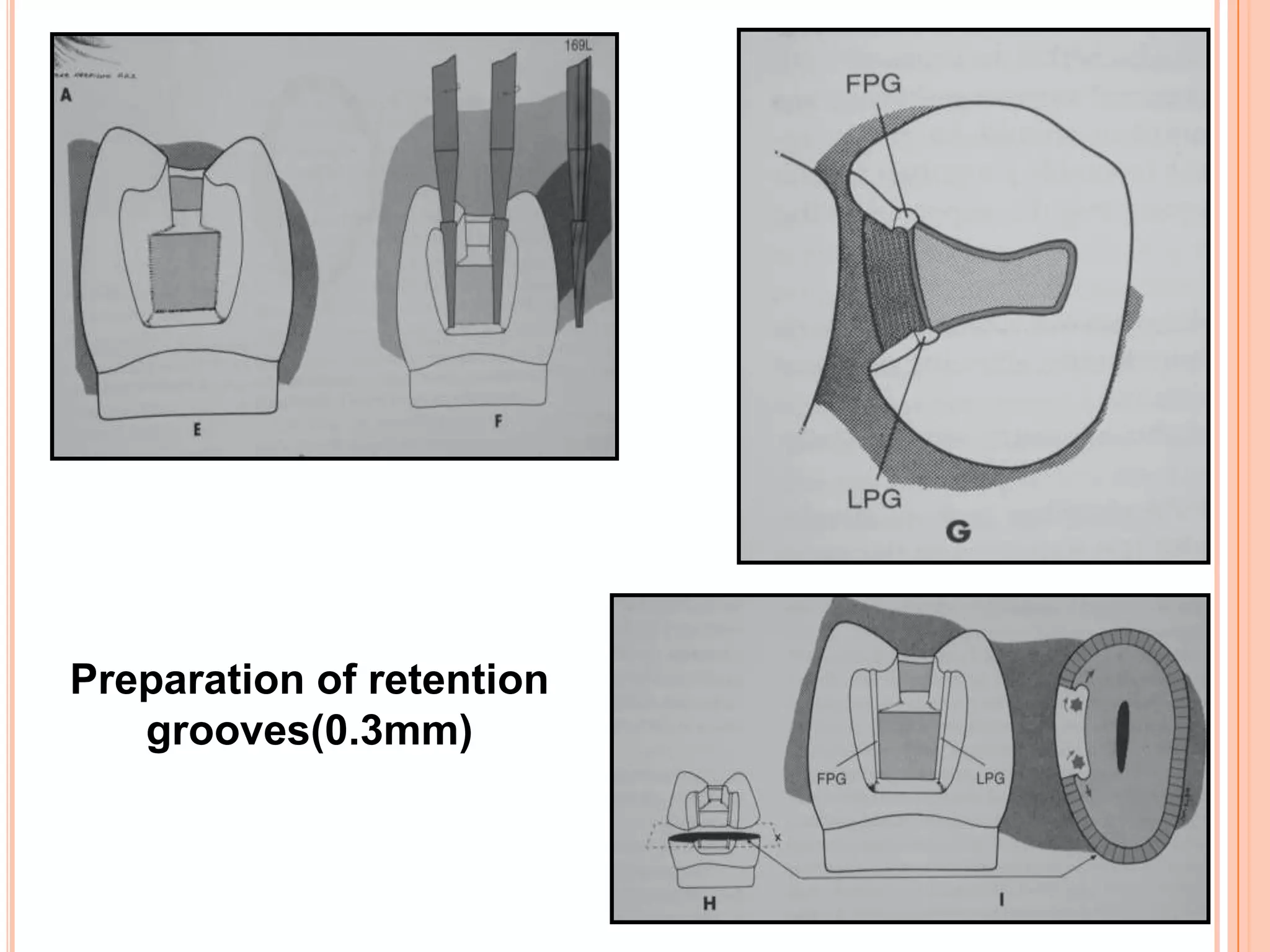 Cast gold Inlay restorations | PPTX