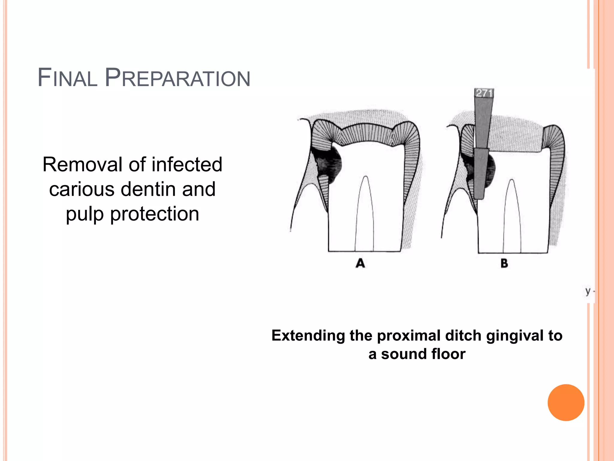 Cast gold Inlay restorations | PPTX