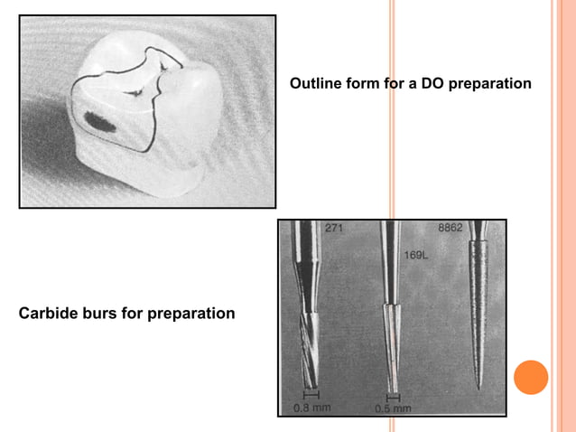 Cast gold Inlay restorations | PPTX
