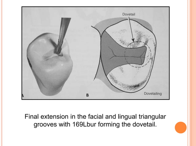 Cast gold Inlay restorations | PPTX