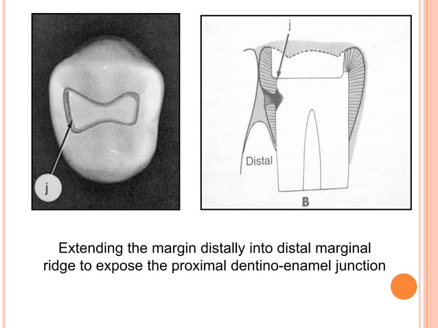 Cast gold Inlay restorations | PPTX