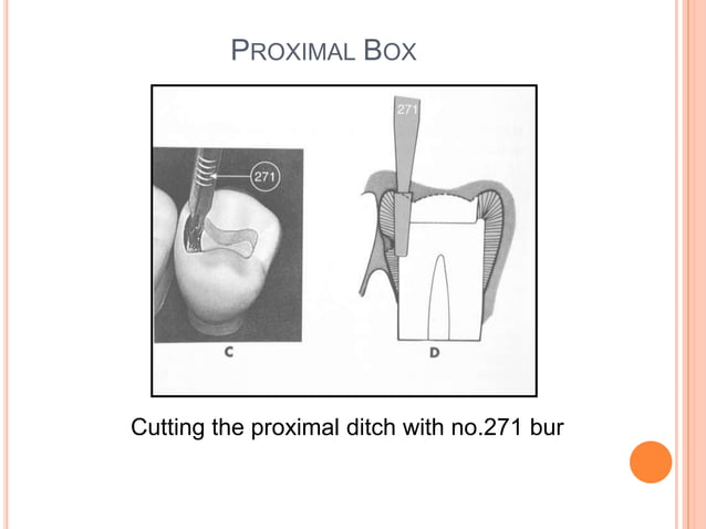 Cast gold Inlay restorations | PPTX