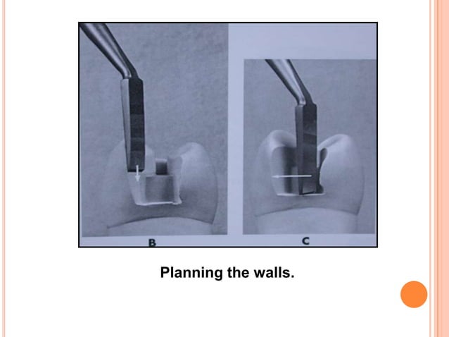 Cast gold Inlay restorations | PPTX