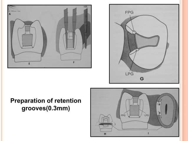 Cast gold Inlay restorations | PPTX