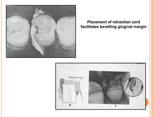 Cast gold Inlay restorations | PPTX