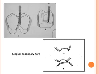 Cast gold Inlay restorations | PPTX