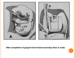 Cast gold Inlay restorations | PPTX
