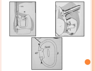 Cast gold Inlay restorations | PPTX