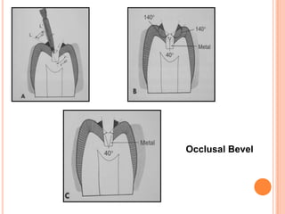 Cast gold Inlay restorations | PPTX