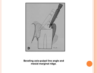 Cast gold Inlay restorations | PPTX