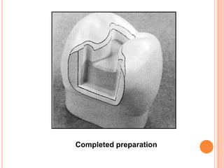 Cast gold Inlay restorations | PPTX