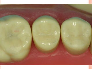 Cast gold Inlay restorations | PPTX