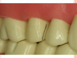 Cast gold Inlay restorations | PPTX