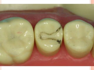 Cast gold Inlay restorations | PPTX