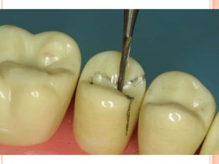 Cast gold Inlay restorations | PPTX