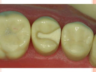 Cast gold Inlay restorations | PPTX