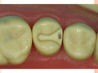 Cast gold Inlay restorations | PPTX