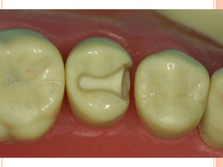 Cast gold Inlay restorations | PPTX