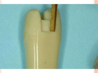 Cast gold Inlay restorations | PPTX