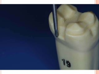 Cast gold Inlay restorations | PPTX