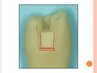 Cast gold Inlay restorations | PPTX