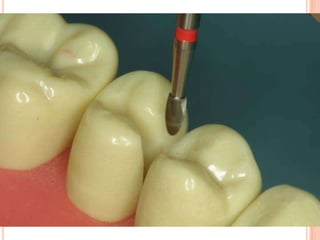 Cast gold Inlay restorations | PPTX