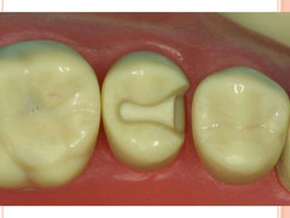 Cast gold Inlay restorations | PPTX