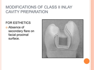 Cast gold Inlay restorations | PPTX