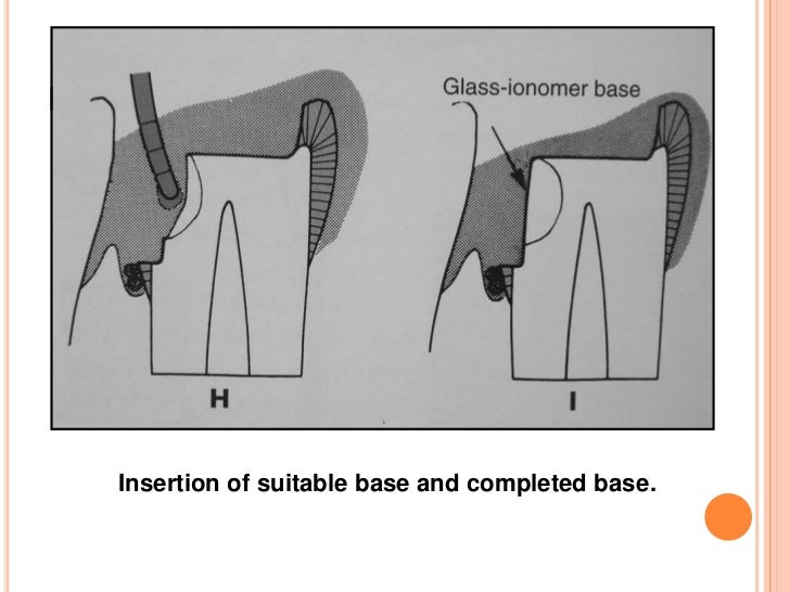 Cast gold Inlay restorations