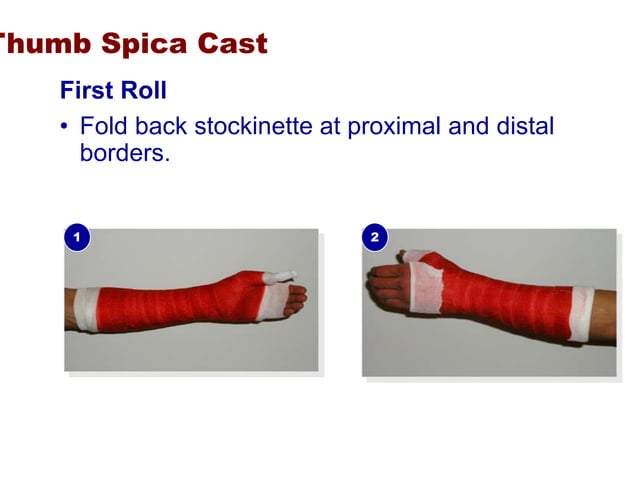 casting-splinting.ppt