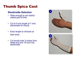 Thumb Spica Cast