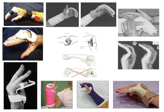 Casting and splinting principles and common pitfalls | PPT | First Aid ...