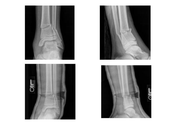 Casting and splinting principles and common pitfalls | PPT | First Aid ...