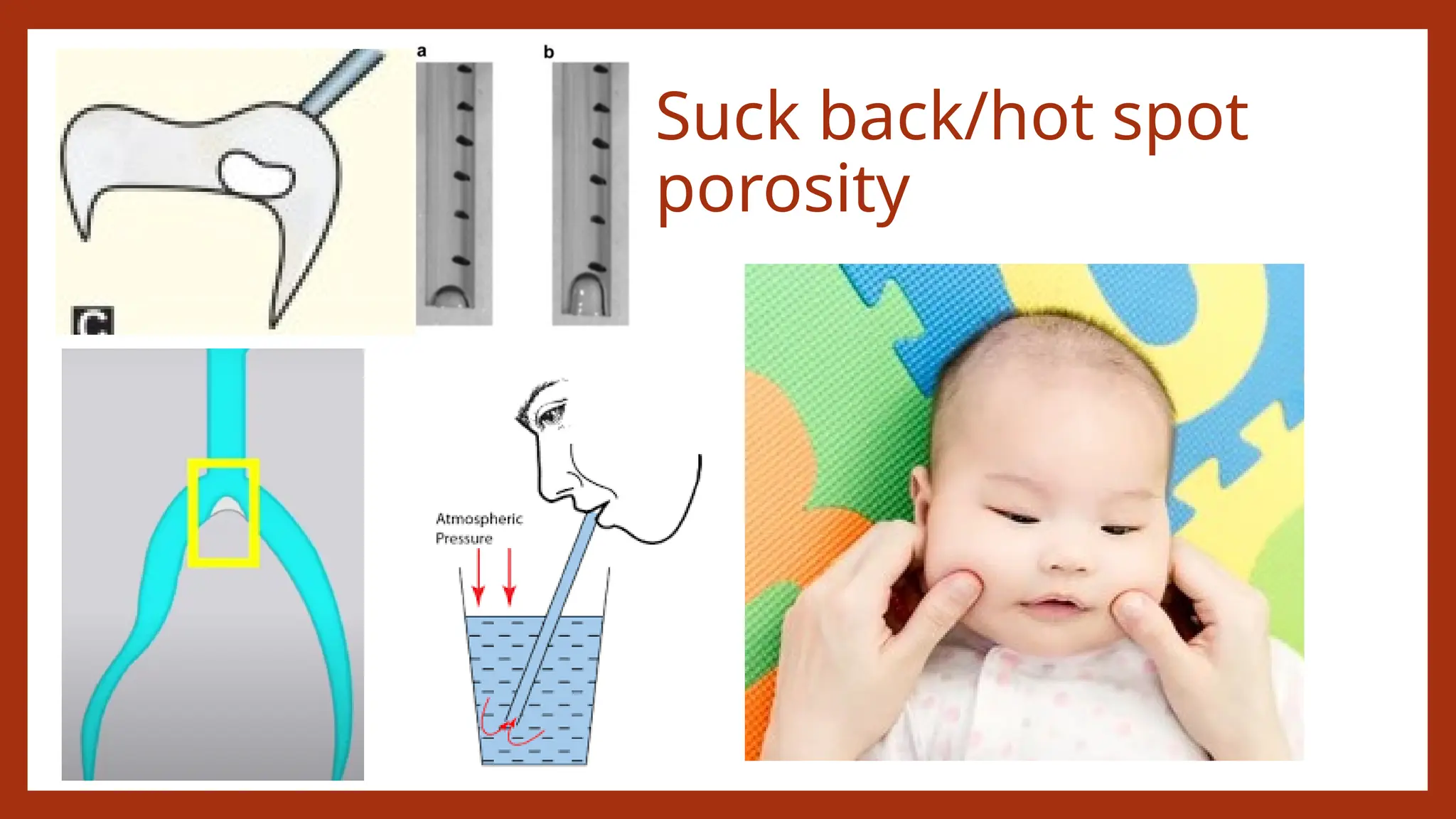 Dental Casting Defects - Dental Materials | PPTX