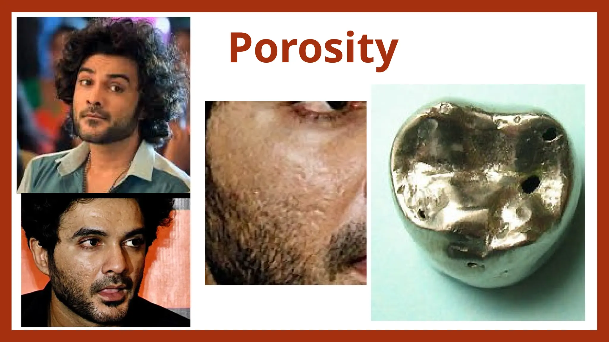 Dental Casting Defects - Dental Materials | PPTX