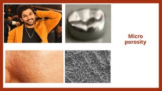 Dental Casting Defects - Dental Materials | PPTX