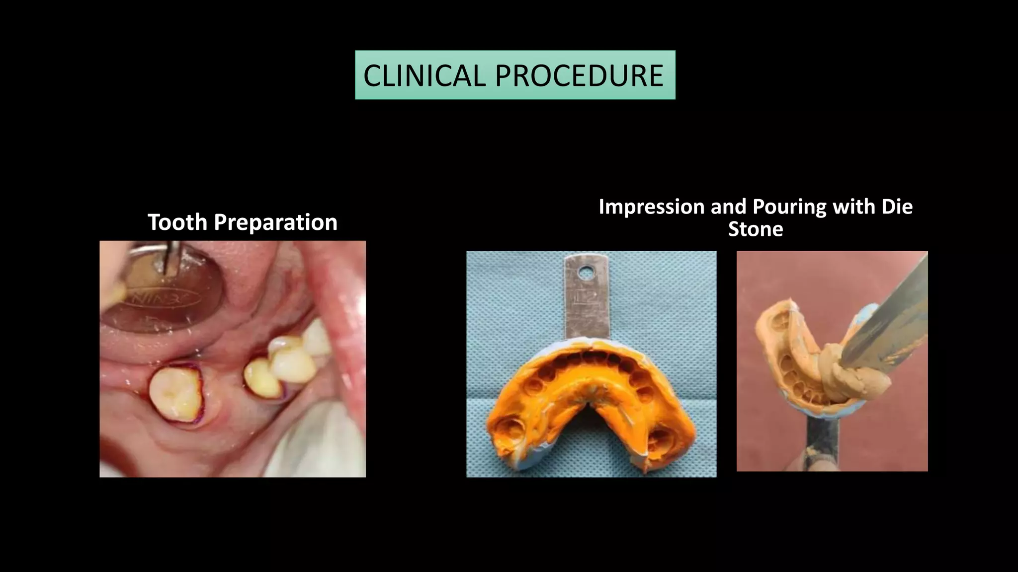 Casting procedures | PPTX