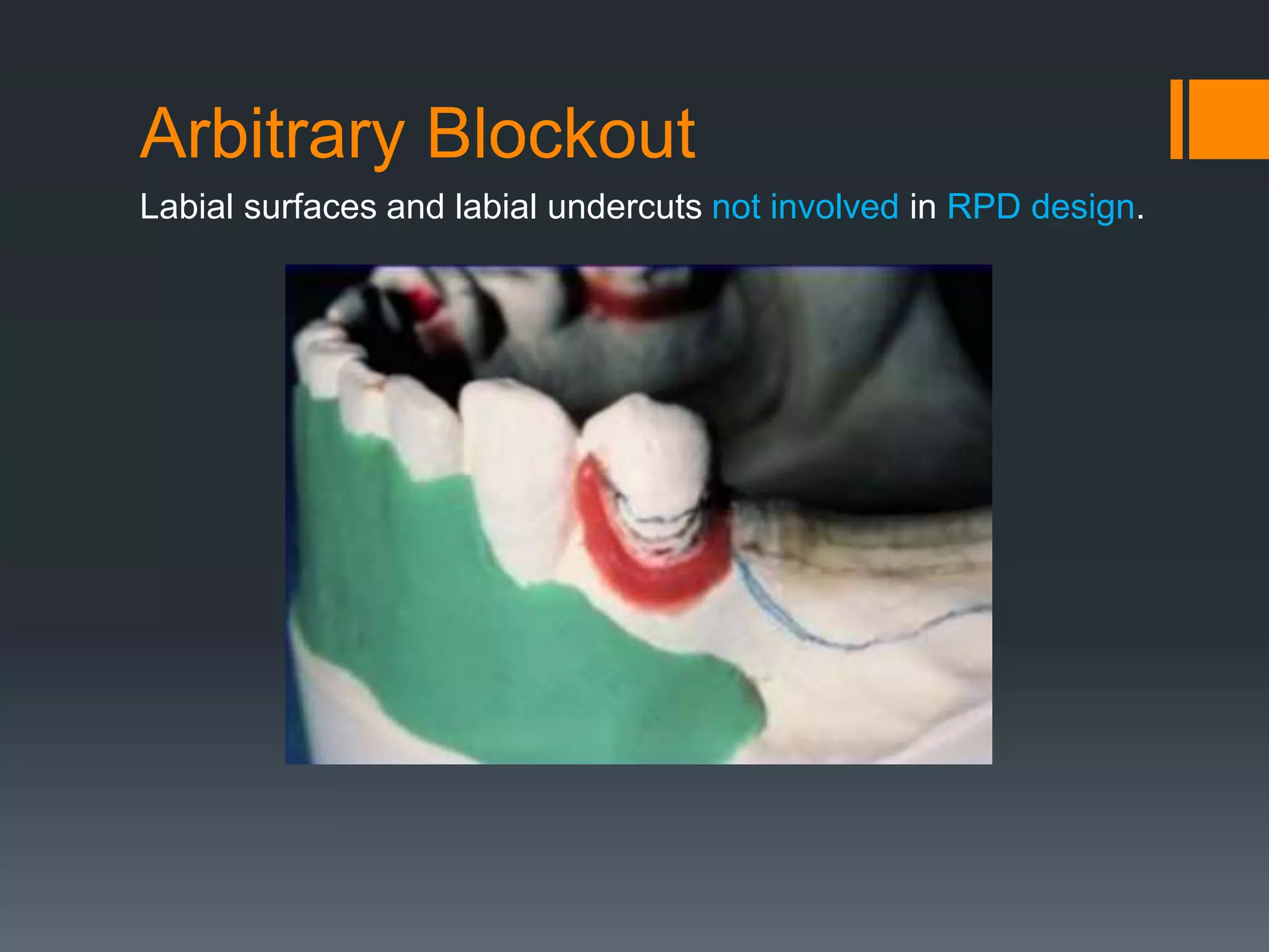 Casting Procedures in Dentistry | PPTX