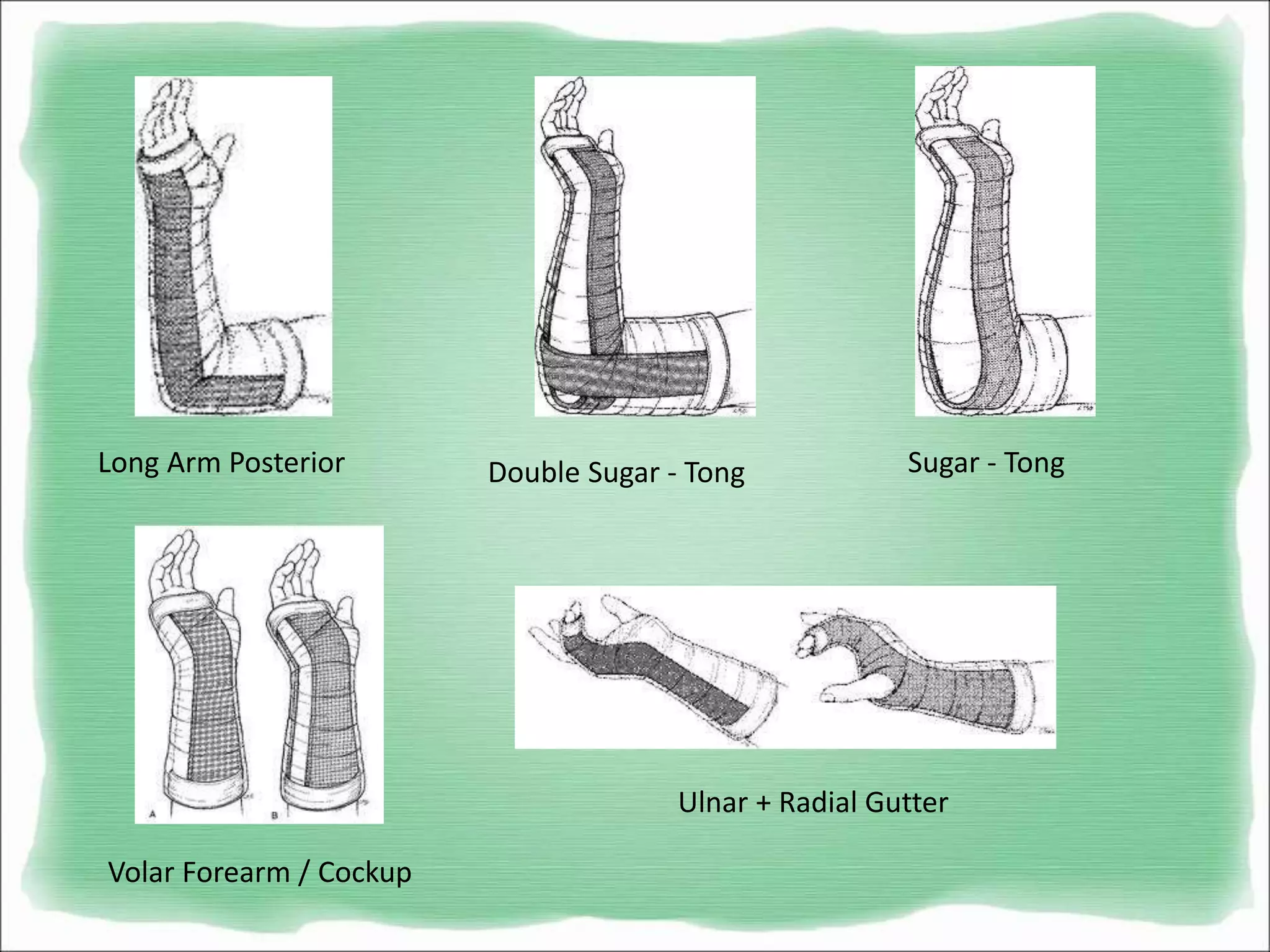 Casting and splinting | PPT