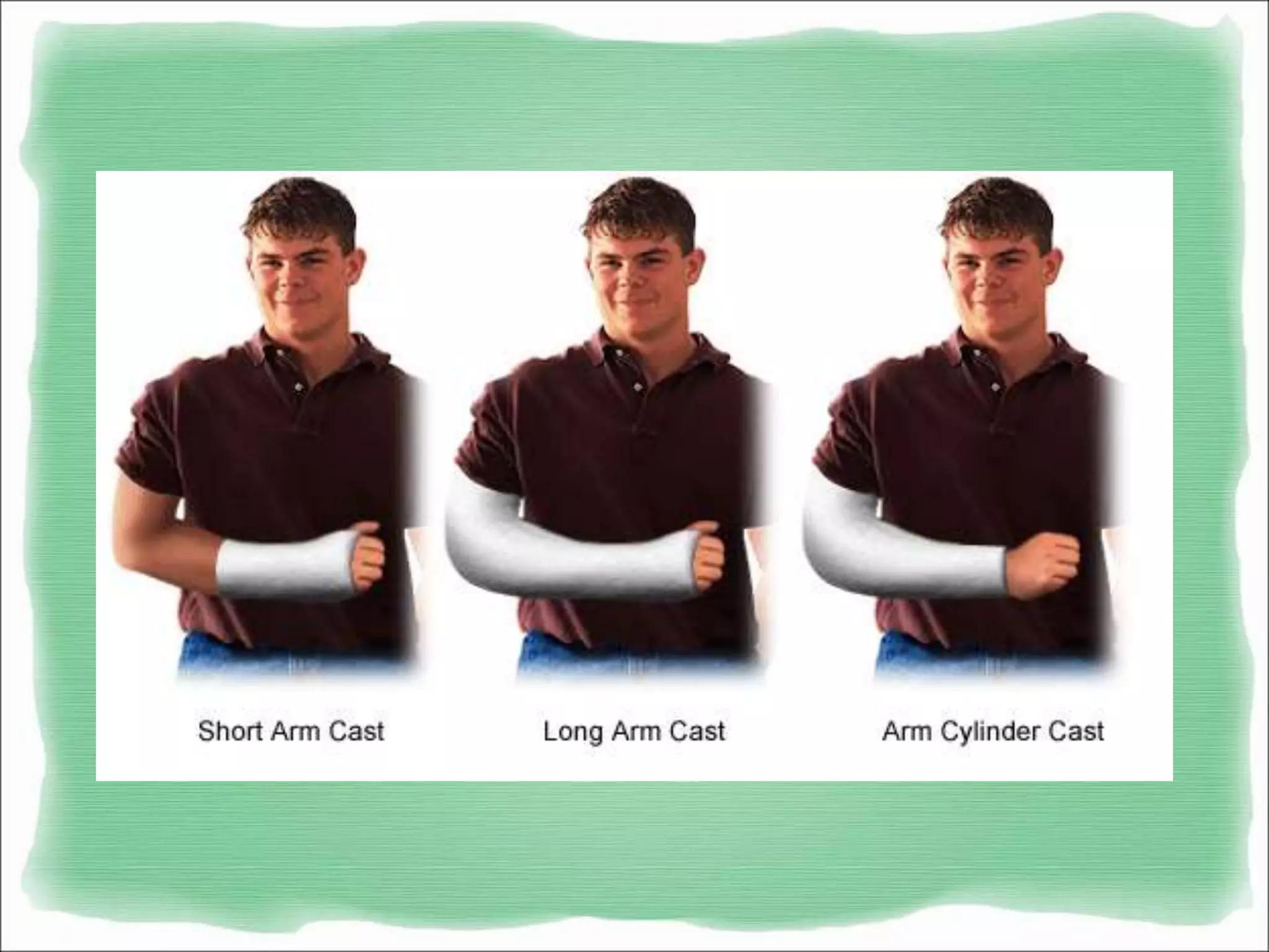 Casting and splinting | PPT