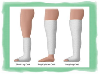 Casting and splinting | PPT