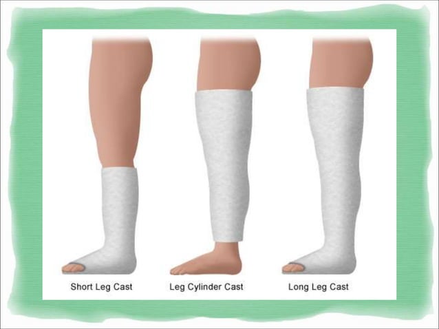 Casting and splinting | PPT | First Aid | Injuries