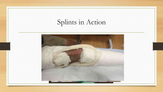 Casting splinting and bracing for wounds | PPT