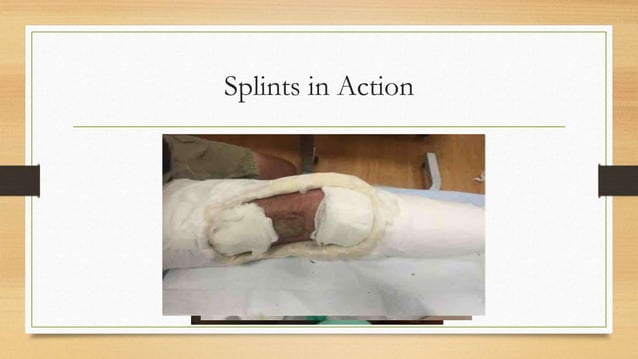 Casting splinting and bracing for wounds | PPT