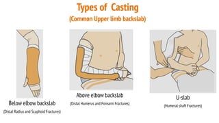 Casting and Splinting presentation for orthopedic residency | PDF