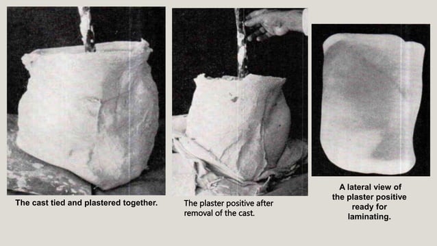 Casting Technique and Modification process of Hip Disarticulation.pptx