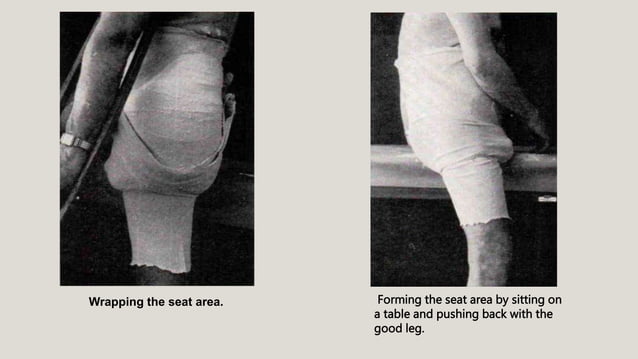 Casting Technique and Modification process of Hip Disarticulation.pptx