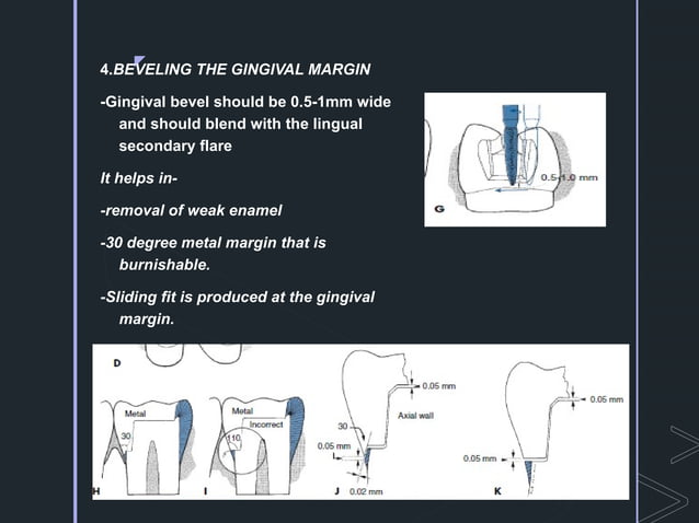 CAST METAL RESTORATIONS IN PROSTHODONTICS.pptx | Dental Health ...